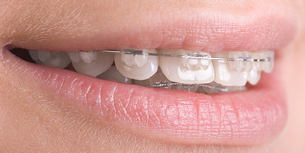 power-braces | Burgess Center for Cosmetic Dentistry